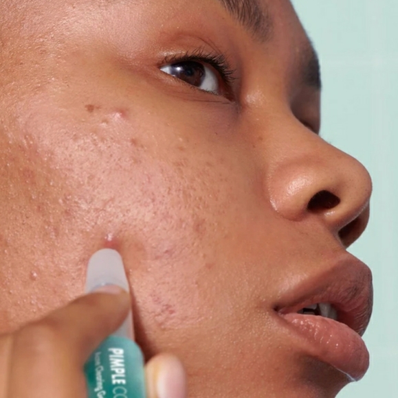 Hero | Grooming | Bnib Hero Cosmetics Pimple Correct Acne Clearing Gel ...